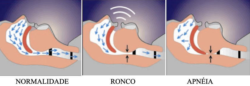 Clínica do Sono & Dor Orofacial – Aparelhos Intra-orais para Apneia e Ronco